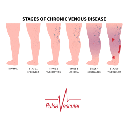 What is CVI? - Pulse Vascular